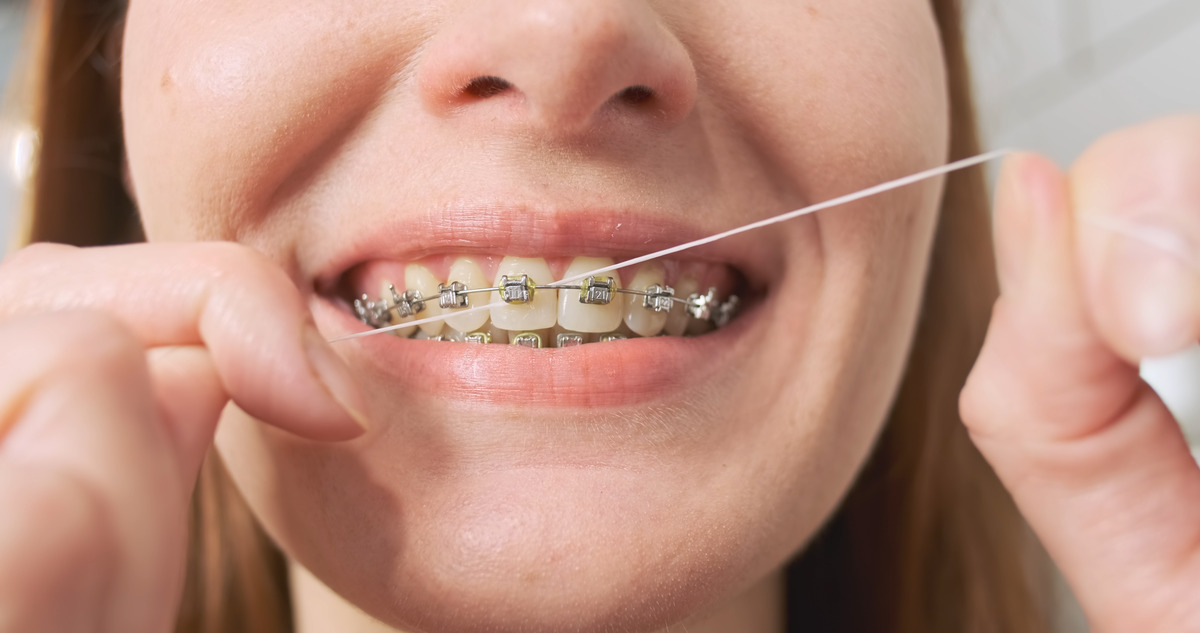 How To Brush & Floss With Braces: Tips & Techniques (2024)